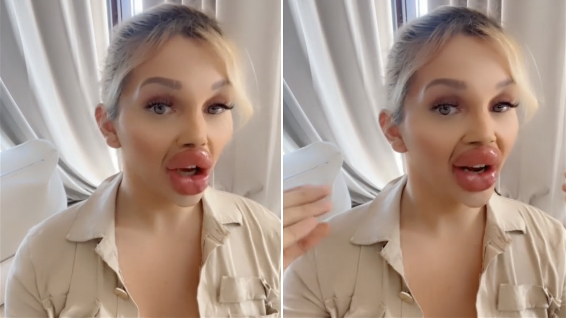 Por Culpa de sus Labios Gigantes, Influencer Vienna Würstel Se Queja ...