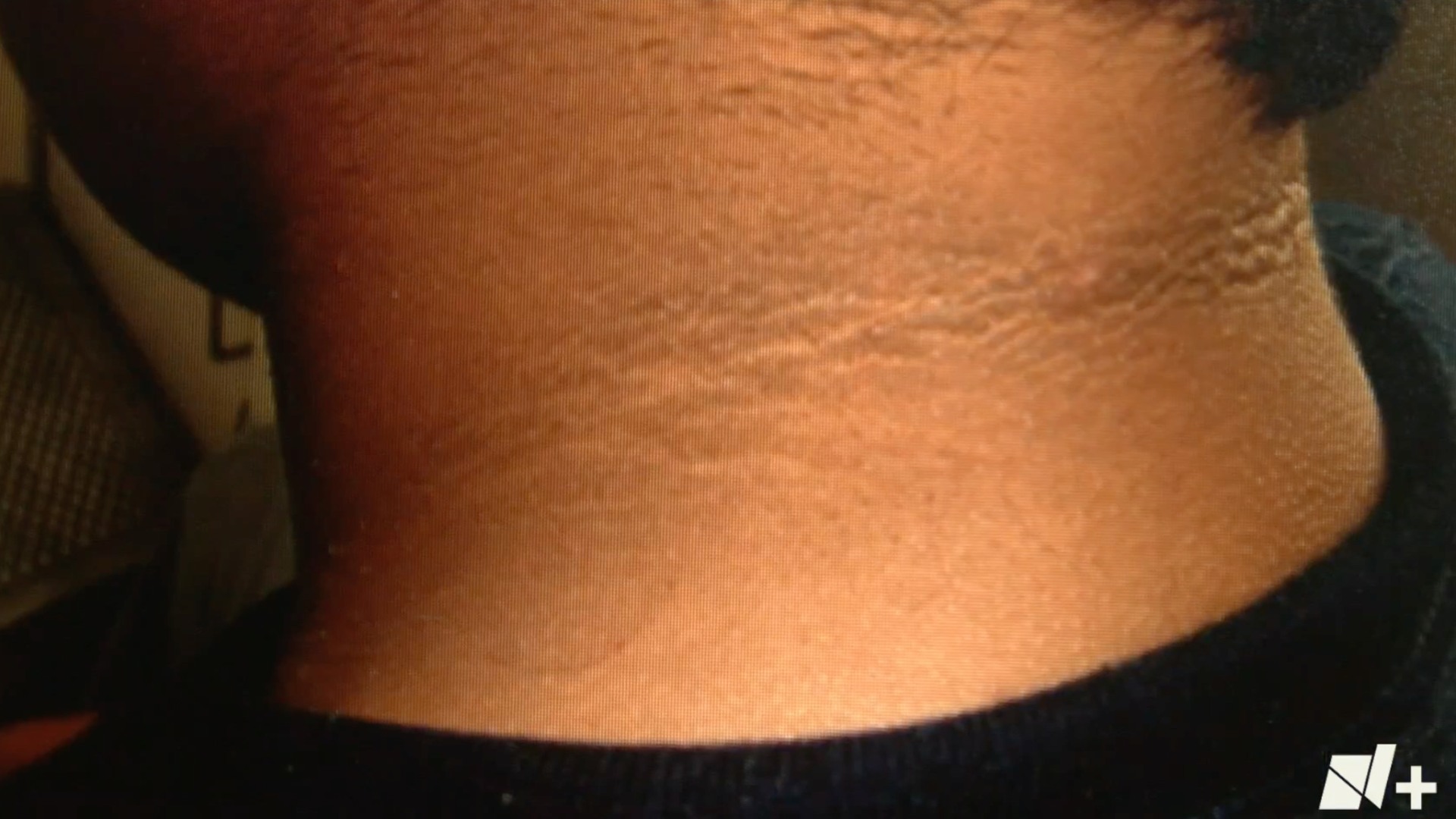 ¿Qué Es la Acantosis y de Que Enfermedades Puede Ser Síntoma? | N+