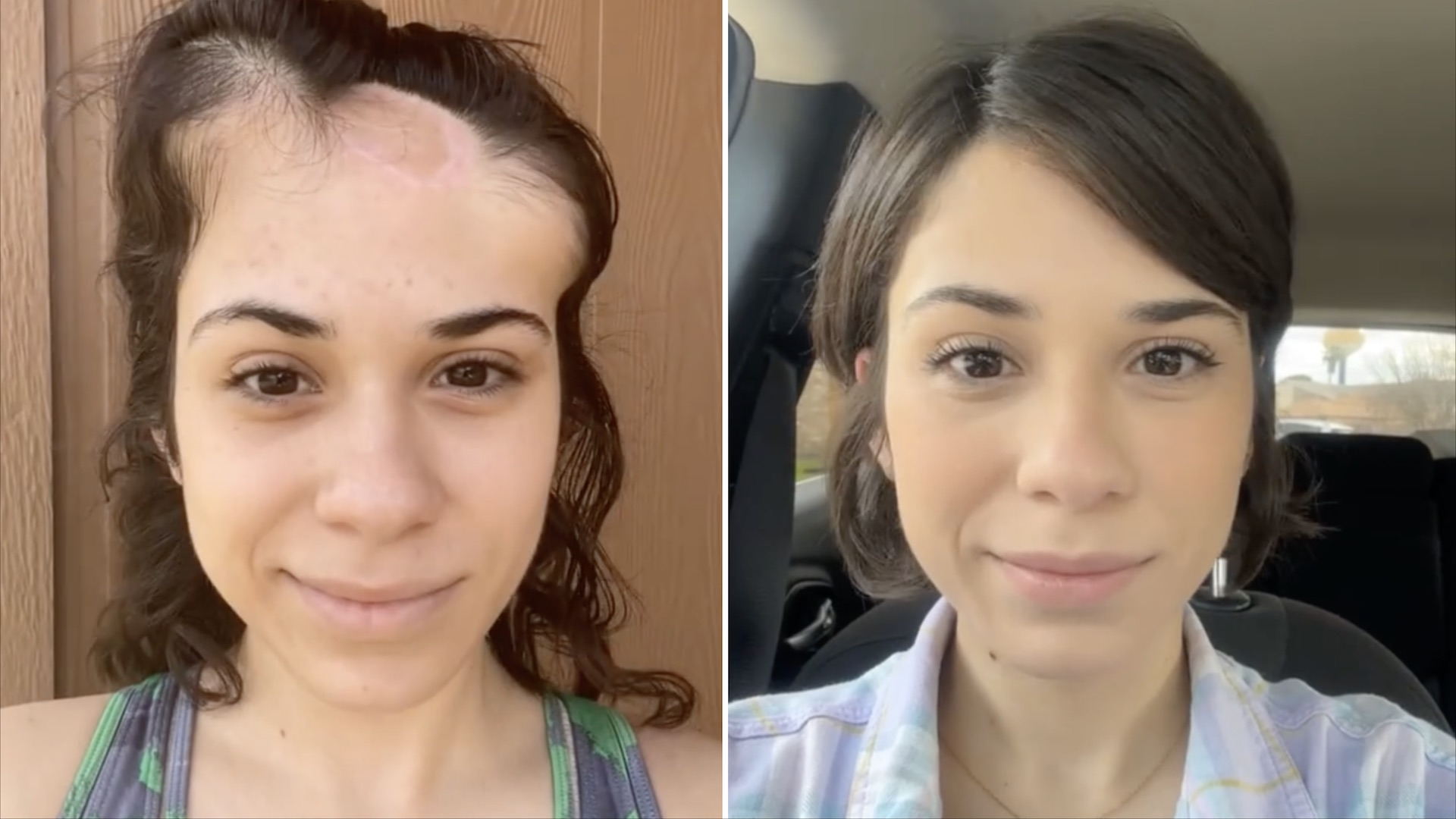 Joven Vence el Cáncer de Piel y Presume Increíble Transformación | N+