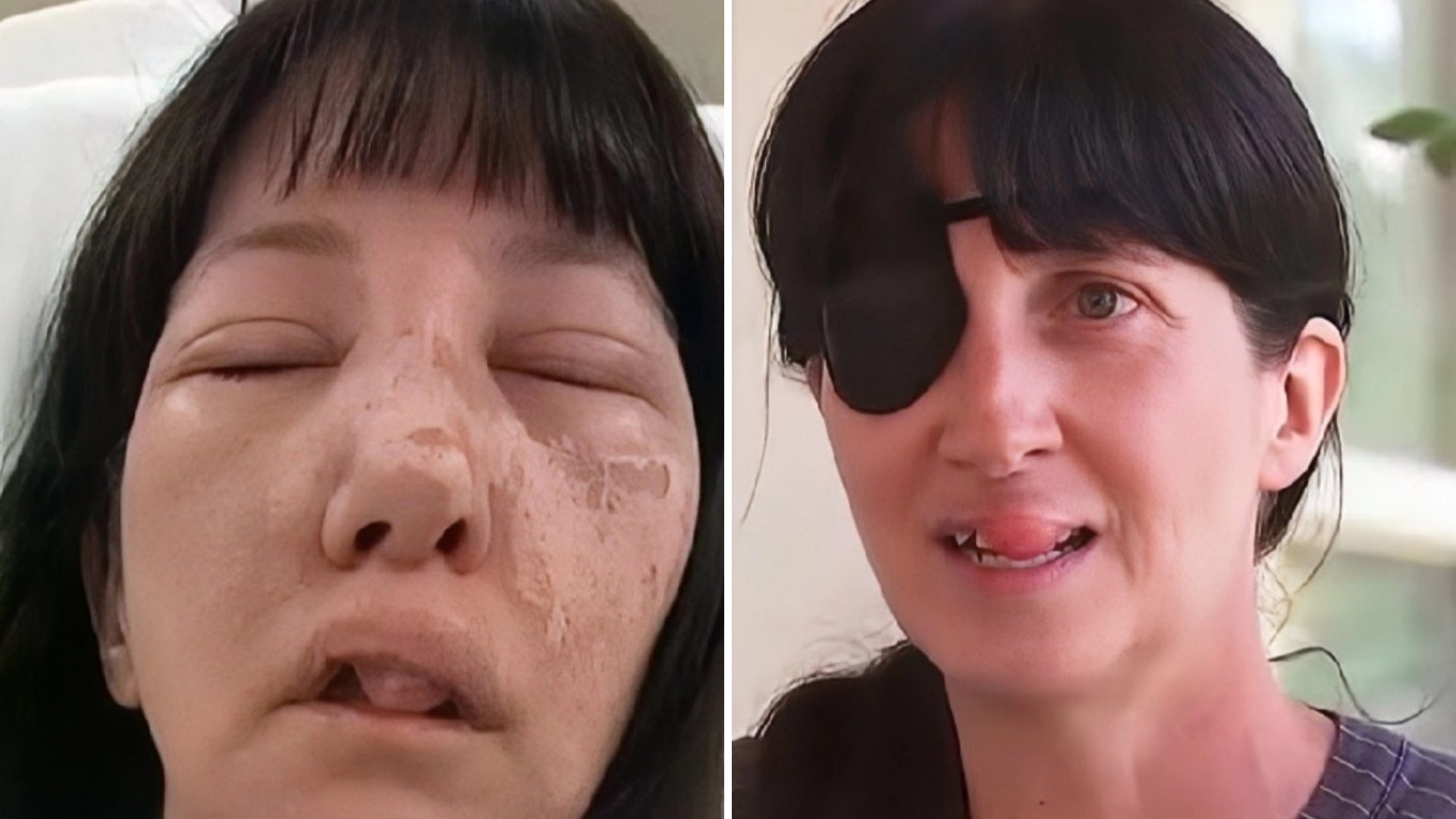 Mujer es Atacada en el Rostro por Arañas Violinistas y Sobrevive | N+