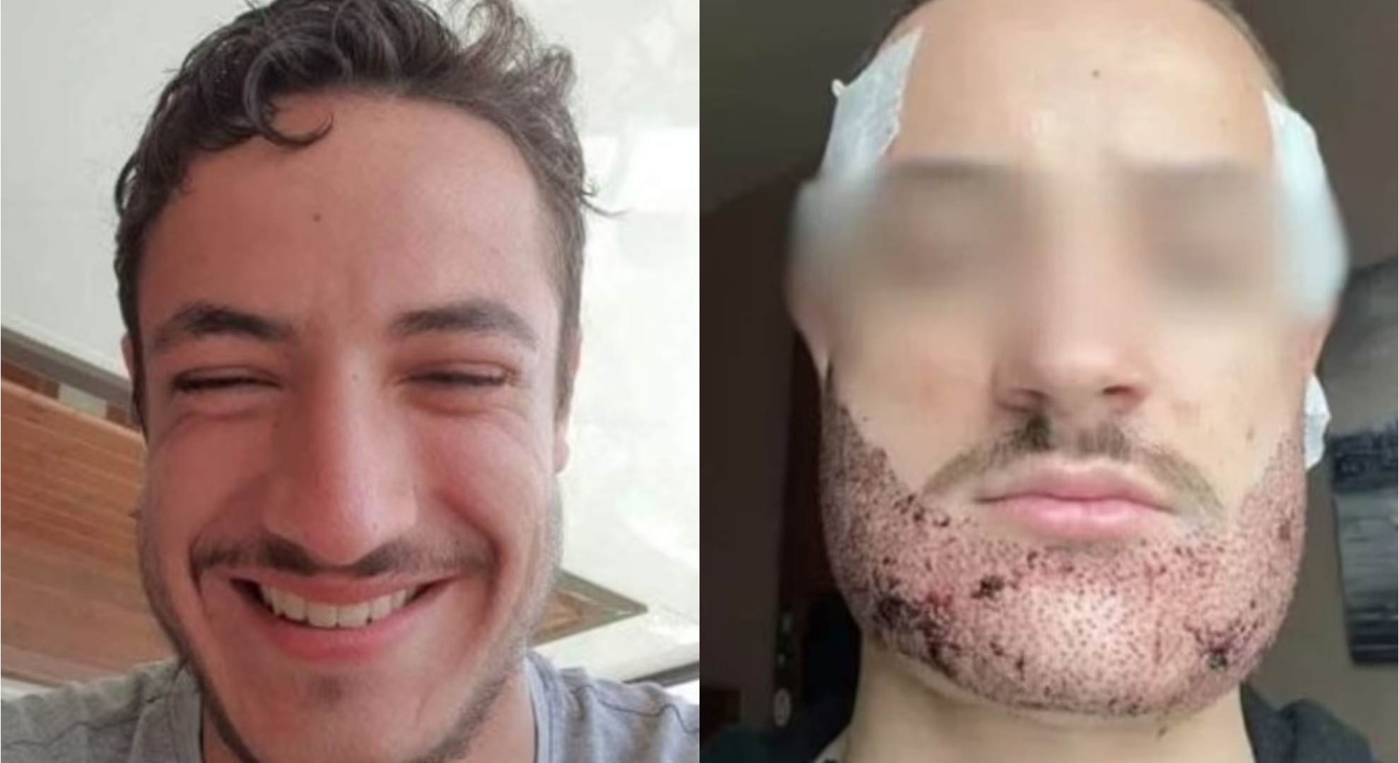 Joven Mathieu Vigier Latour Muere luego de Trasplante de Barba y ...