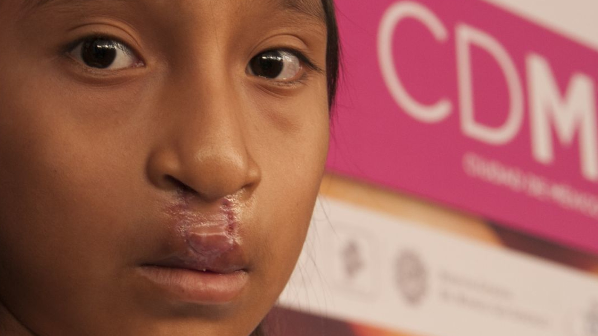 Día Mundial de la Sonrisa 2024: Los Retos al Nacer con Labio y Paladar ...