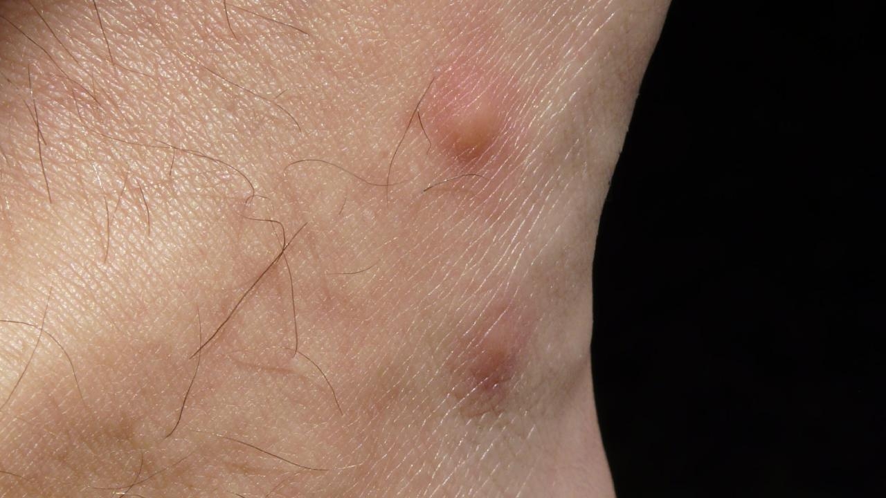 Picaduras de Insectos: ¿Cómo Identificar los Distintos Tipos de ...