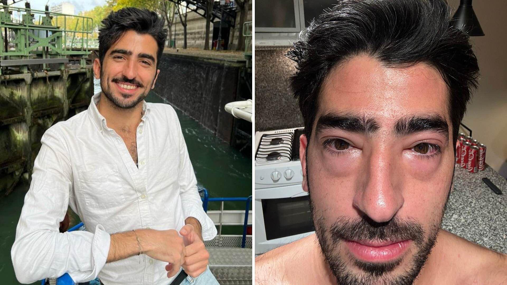 ¿Qué le Pasó a Jezzini? Aparece con Ojos Hinchados y se Vuelve Meme | N+