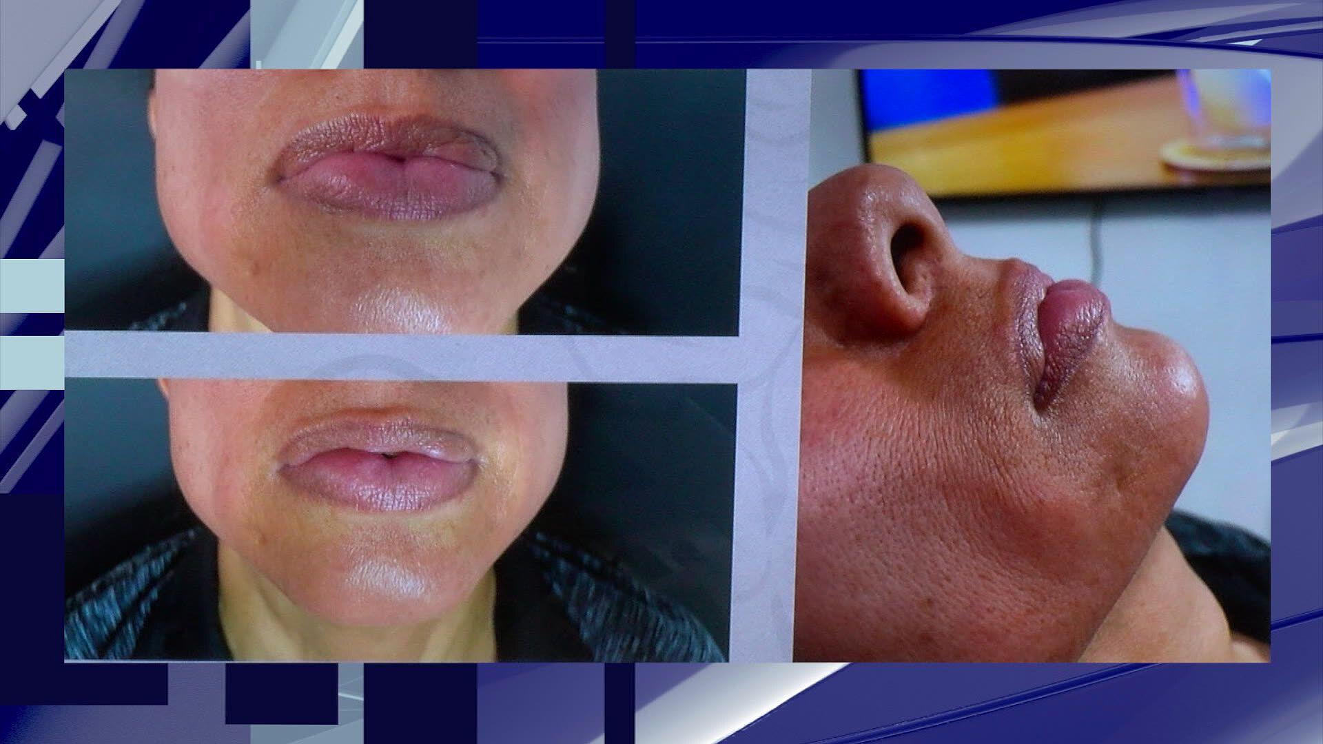 Cofepris Alerta Riesgo por Uso de Botox Sin Registro | N+