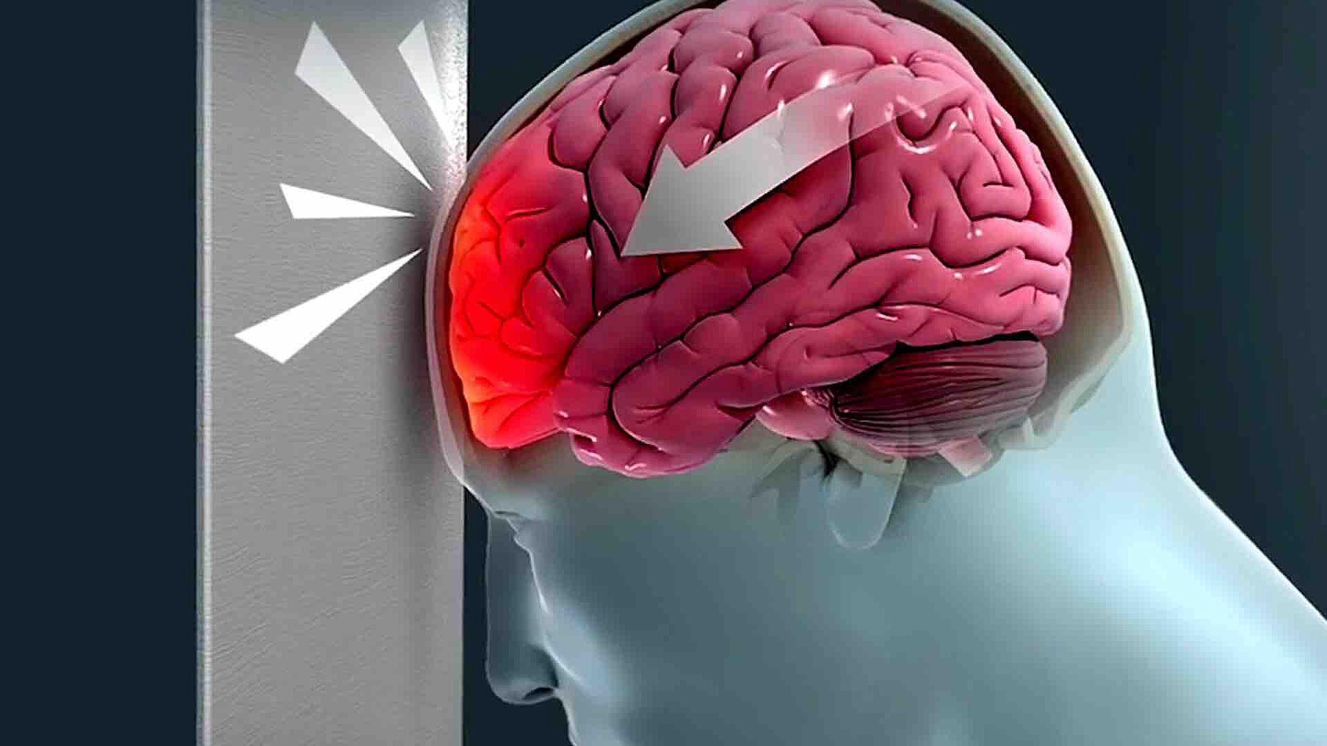 Lesiones Cerebrales Traumáticas Afectan a 70 millones de Personas Anualmente | N+