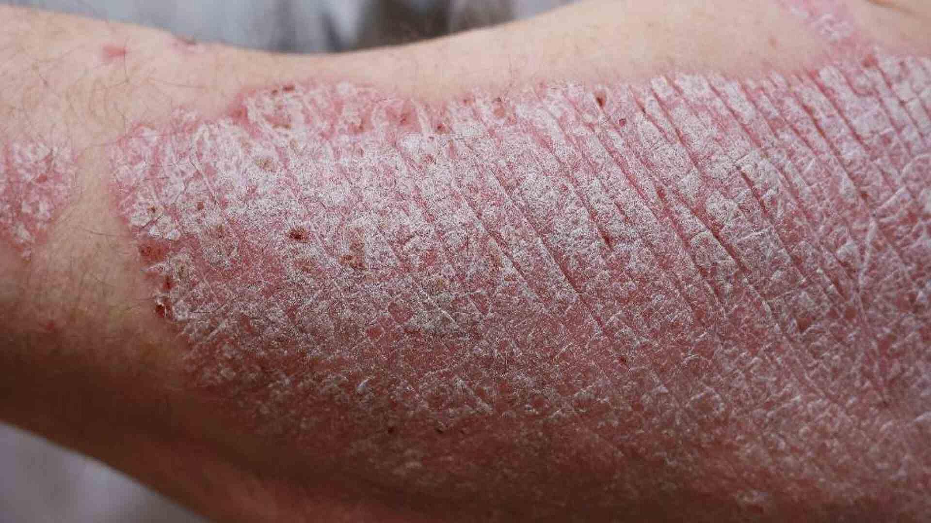 ¿Qué Es el Lupus y Cuál Es su Tratamiento? | N+