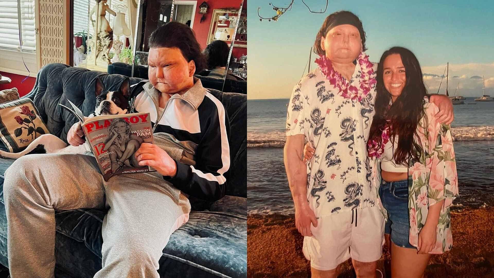 Tras Fuerte Accidente y Transplante de Rostro, Joe Dimeo Encontró el ...