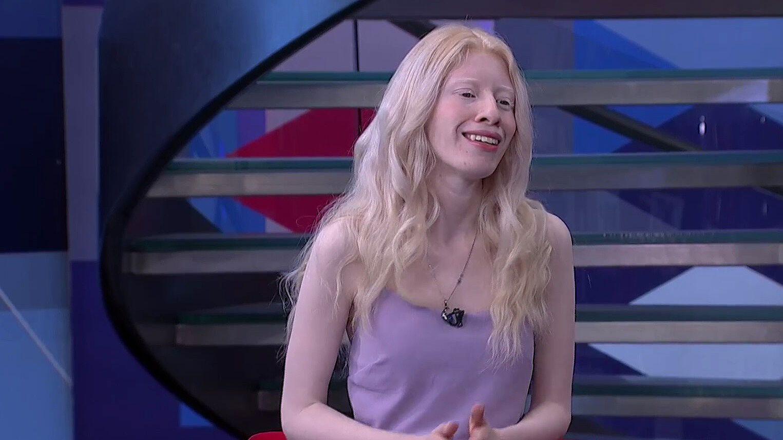 Paola Rojas entrevista a Ruby Vizcarra, modelo albina mexicana | N+