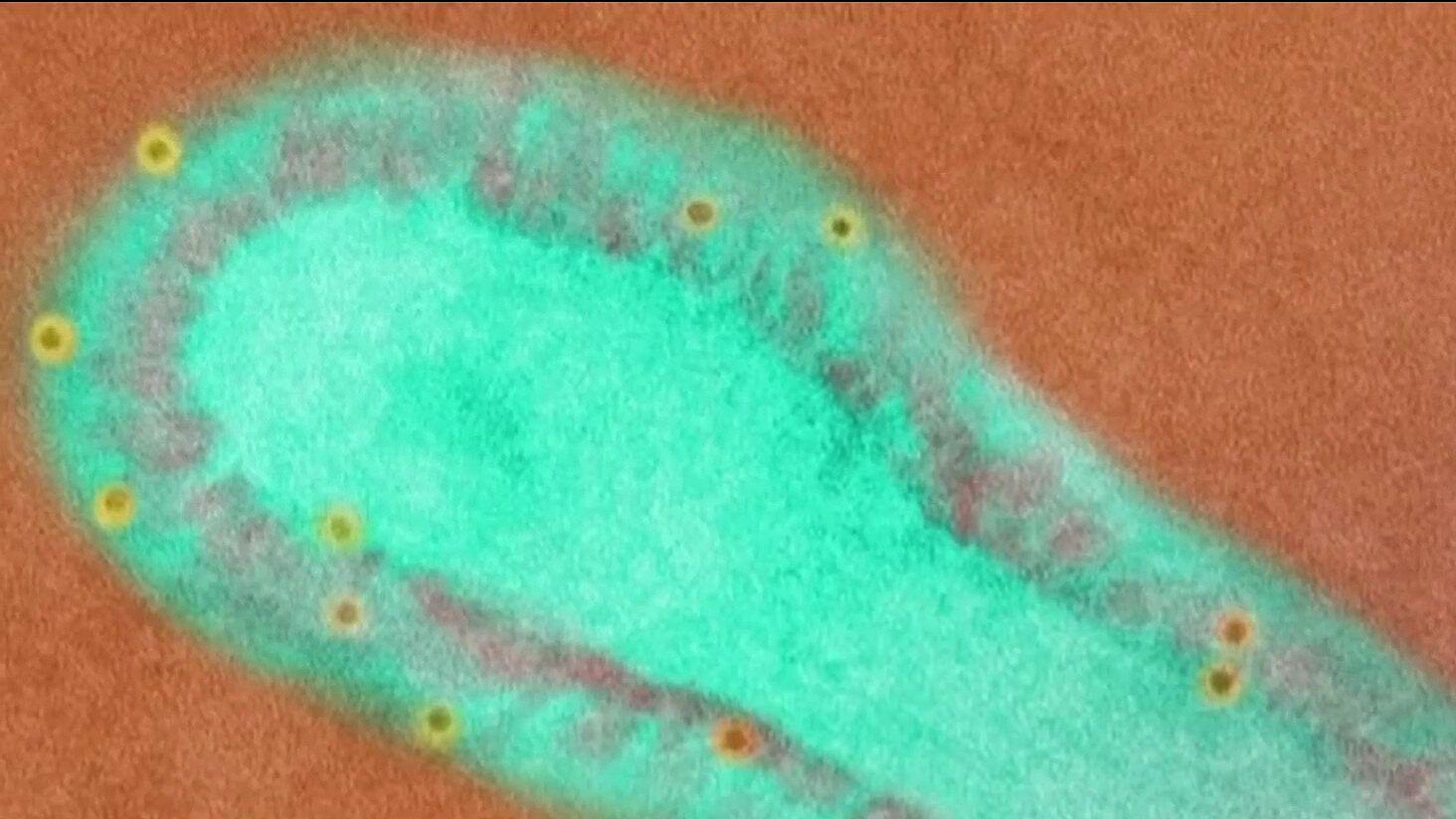 ¿qué Es El Virus Sincicial Respiratorio Y Cómo Se Cura N