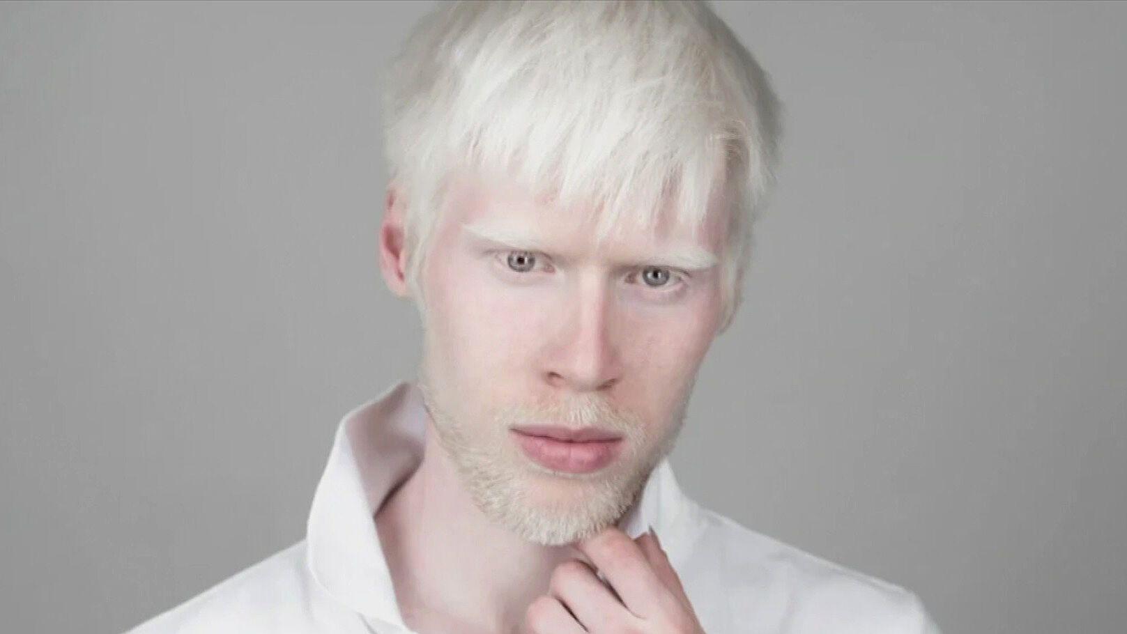 ¿Qué Es el Albinismo? | N+